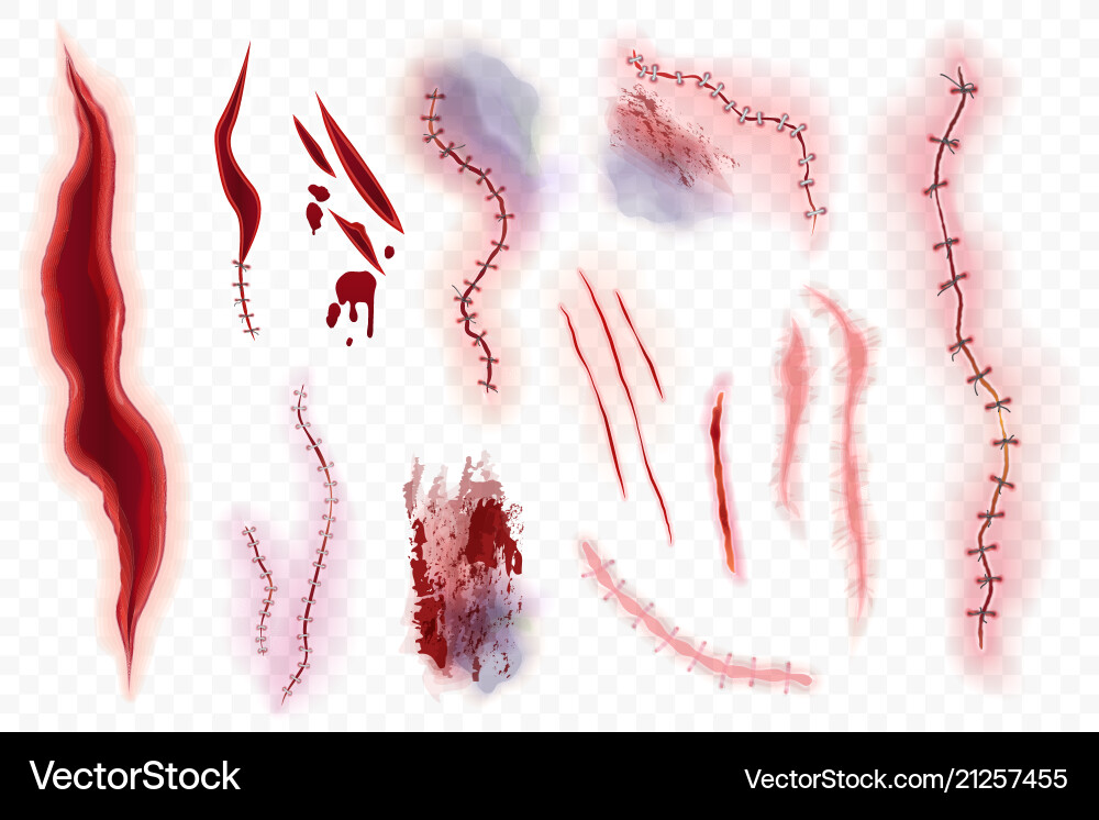 Realistic surgical stitches scars bruise Vector Image