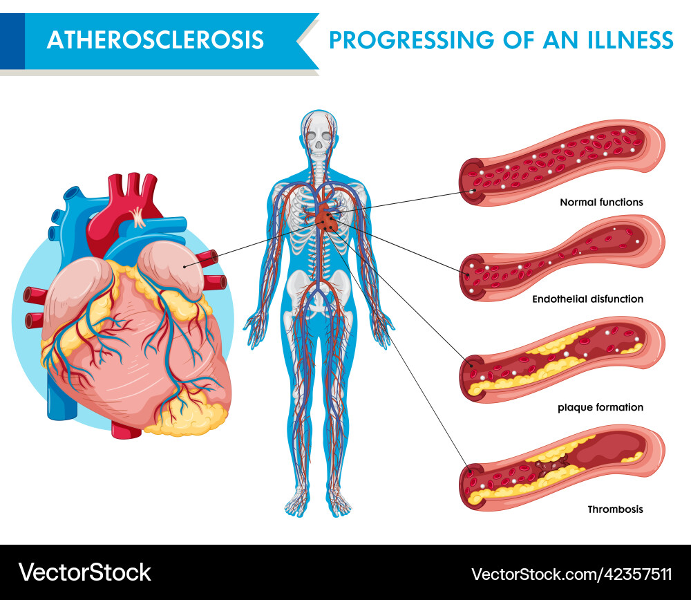 Atherosclerosis progression of an illness Vector Image