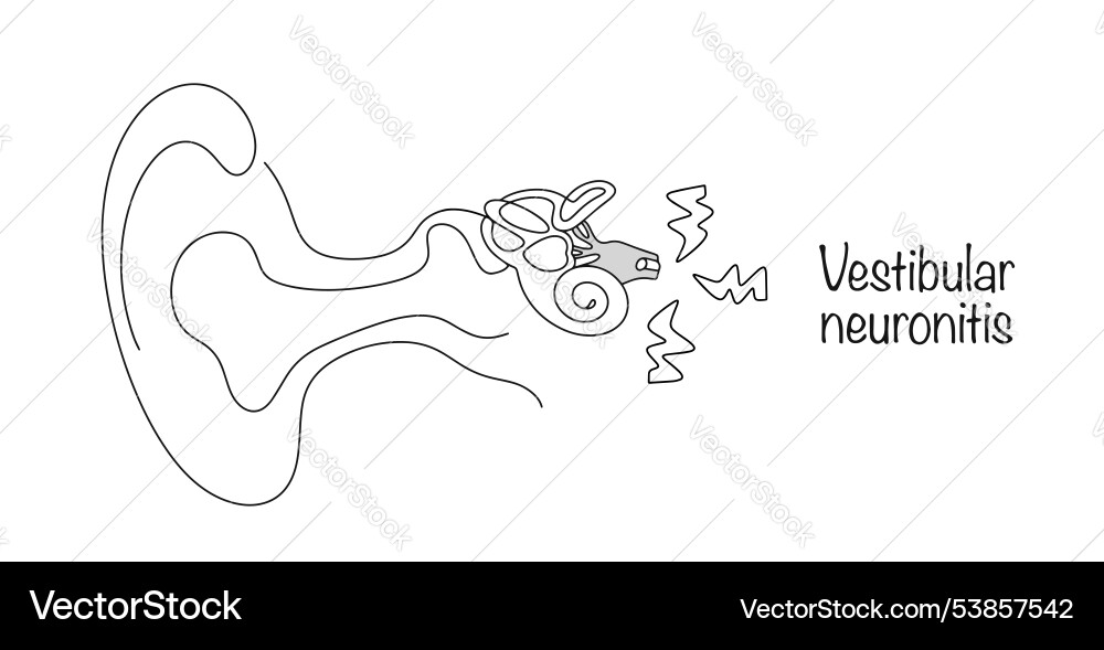 Vestibular neuronitis Royalty Free Vector Image
