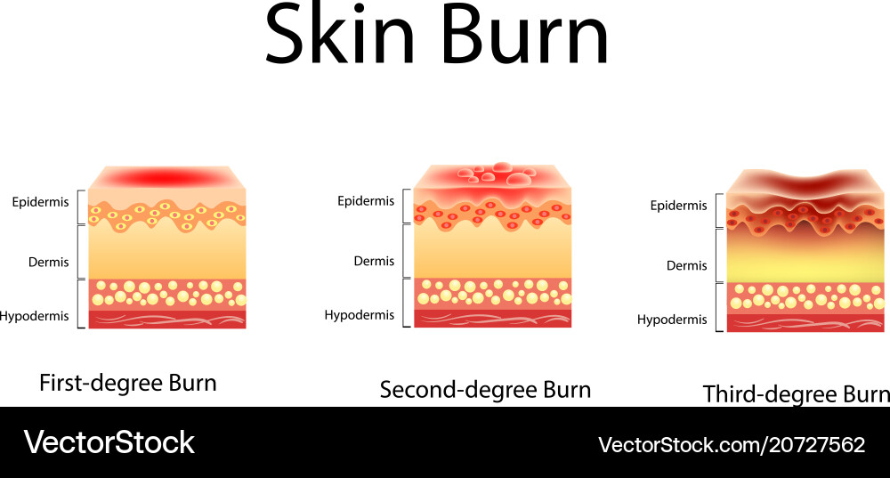 Three Degrees of Burn Injury Royalty Free Vector Image