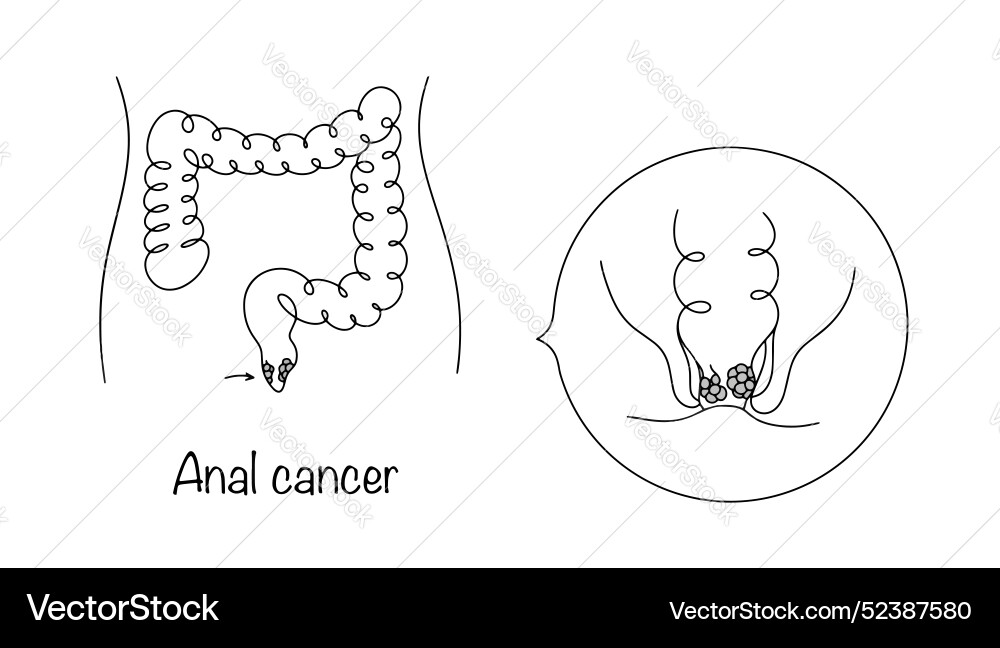 Anal cancer Royalty Free Vector Image - VectorStock