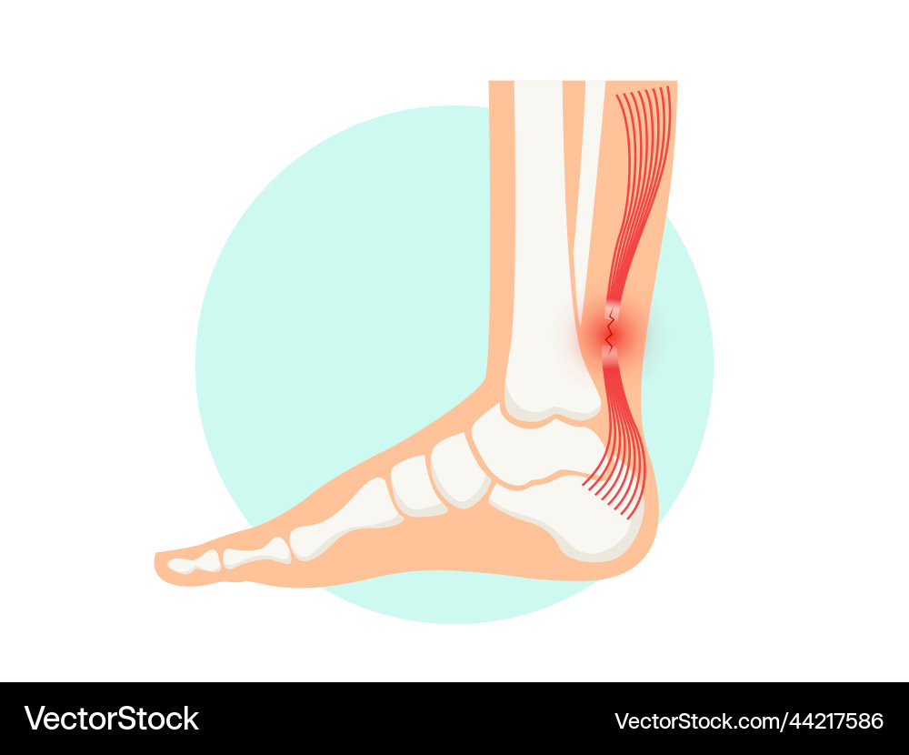 Achilles tendon rupture anatomical poster ankle Vector Image