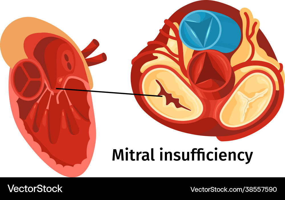 Heart disease poster Royalty Free Vector Image