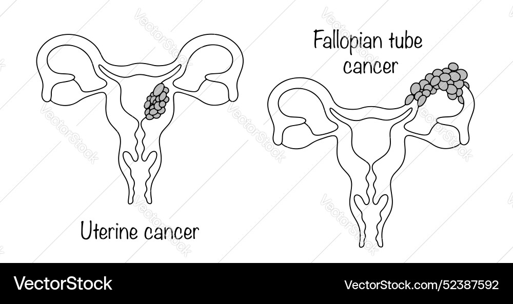 Uterine cancer fallopian tube Royalty Free Vector Image
