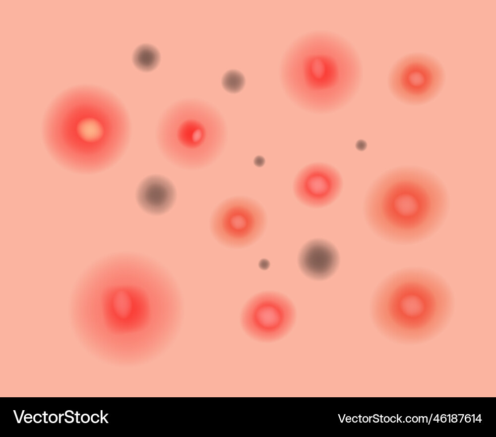 Types of acne diagram skincare problems Royalty Free Vector