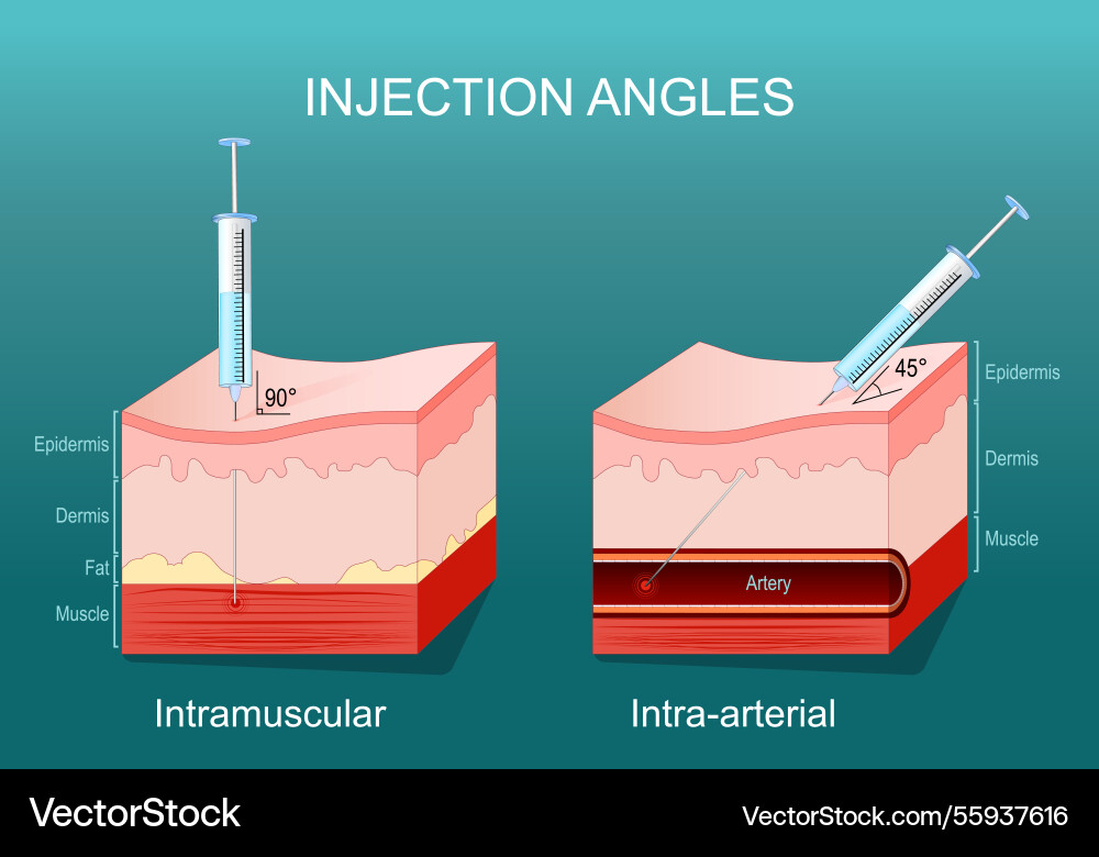 Intra-arterial and intramuscular injections Vector Image