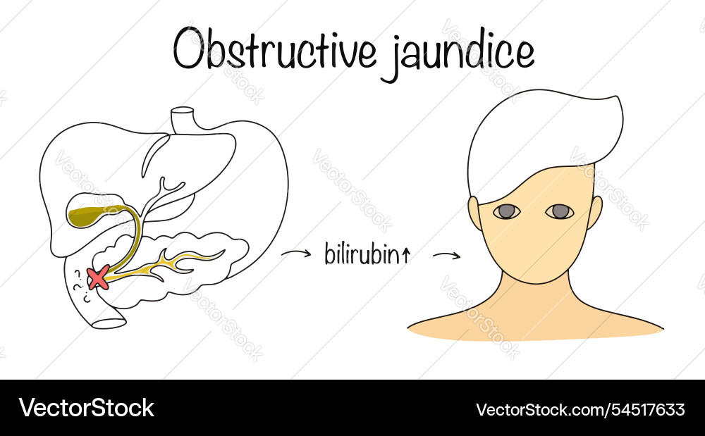 Obstructive jaundice Royalty Free Vector Image