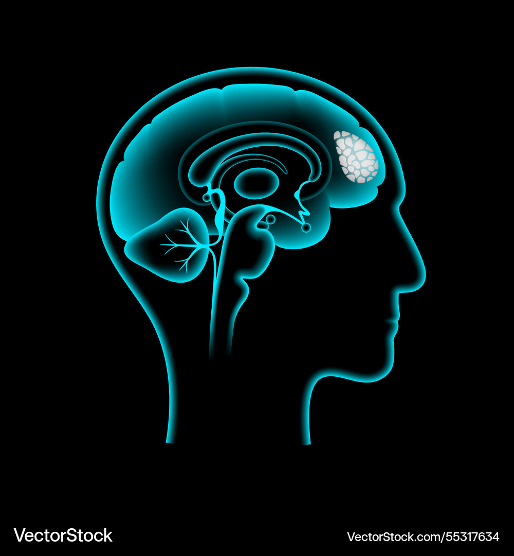 Brain cancer poster Royalty Free Vector Image - VectorStock