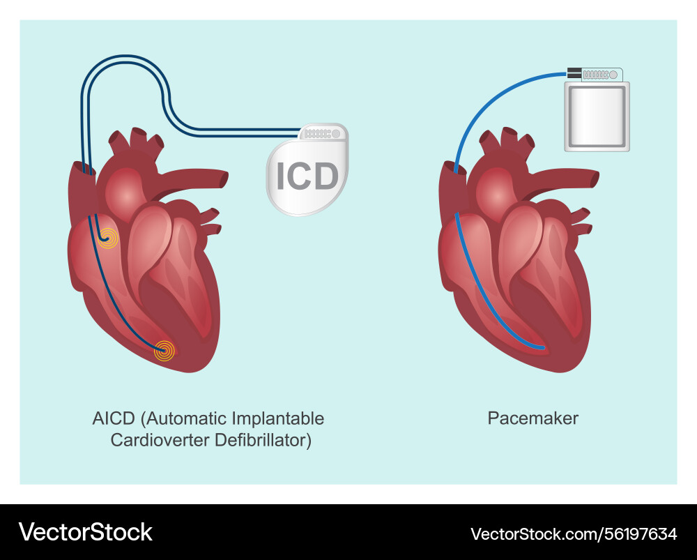Difference between icds and pacemakers Royalty Free Vector