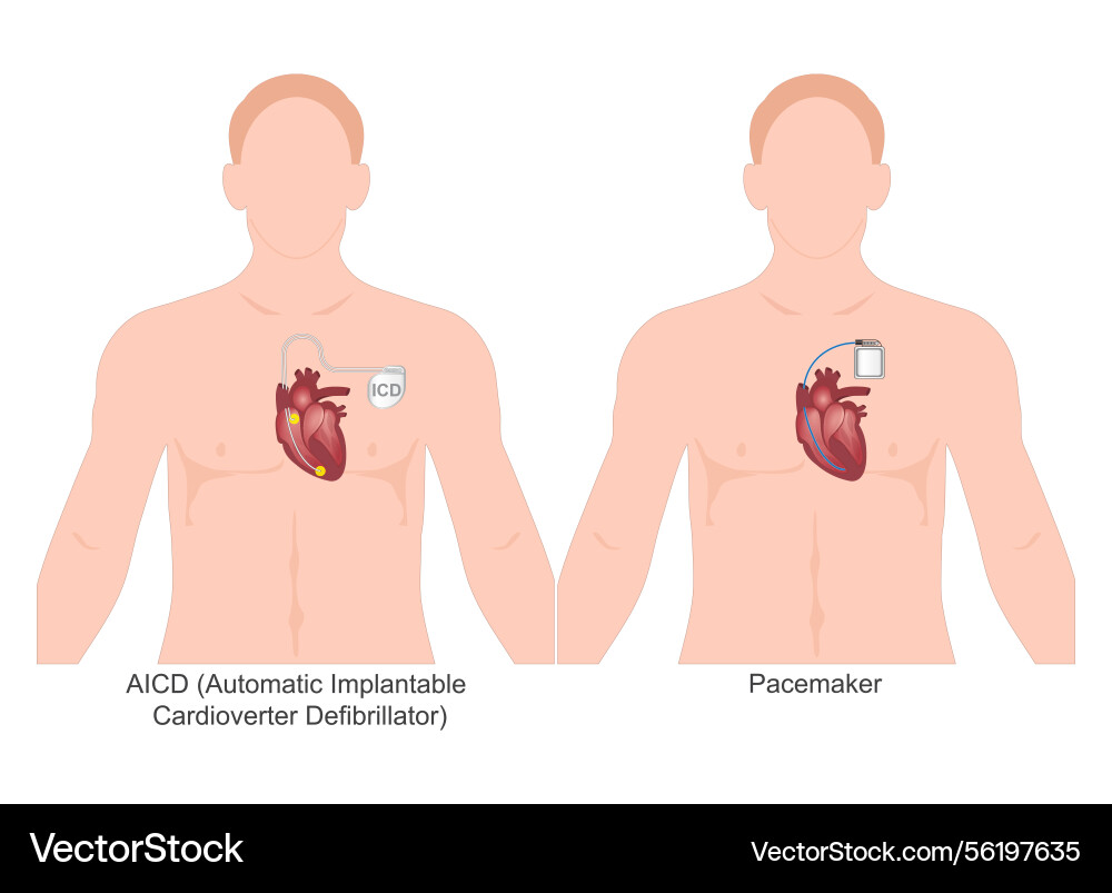 Difference between pacemakers and icds Royalty Free Vector