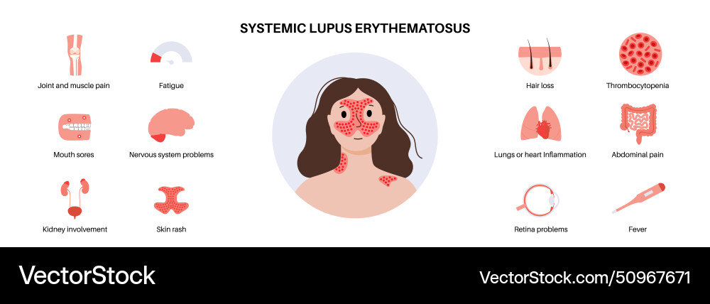 Systemic lupus erythematosus Royalty Free Vector Image
