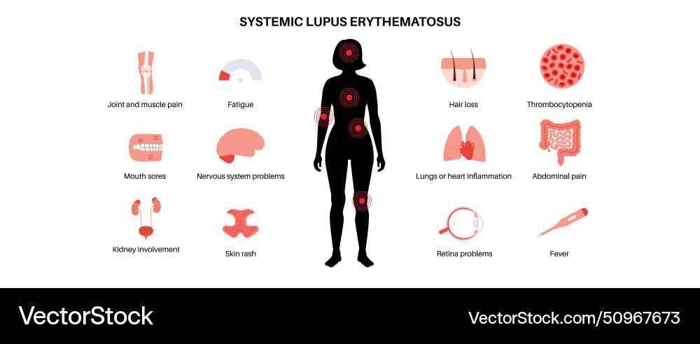 Systemic Lupus