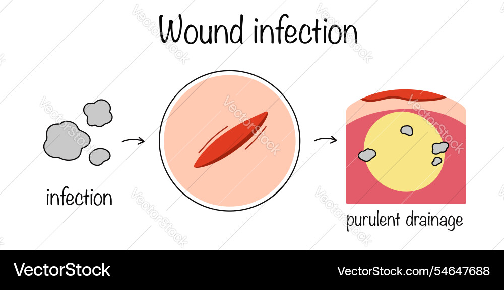 Wound infection Royalty Free Vector Image - VectorStock