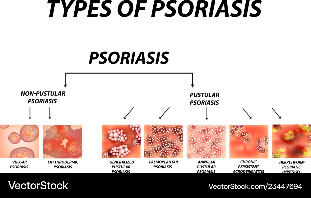 Types of psoriasis pustular Royalty Free Vector Image