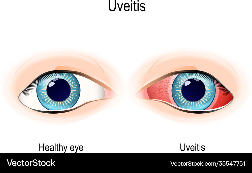 Uveitis Vector Images (38)