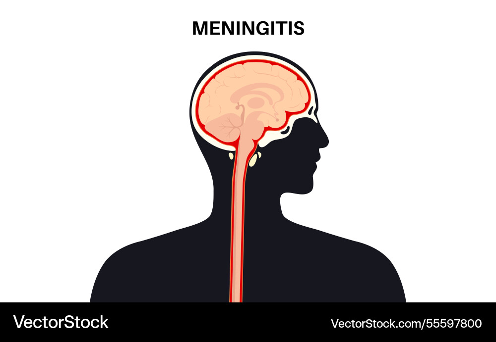 Meningitis medical poster Royalty Free Vector Image