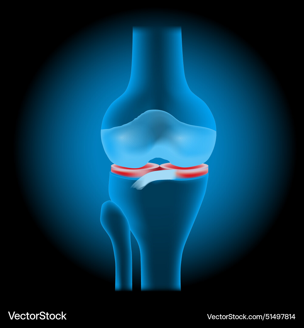Knee meniscus injuries joint anatomy Royalty Free Vector