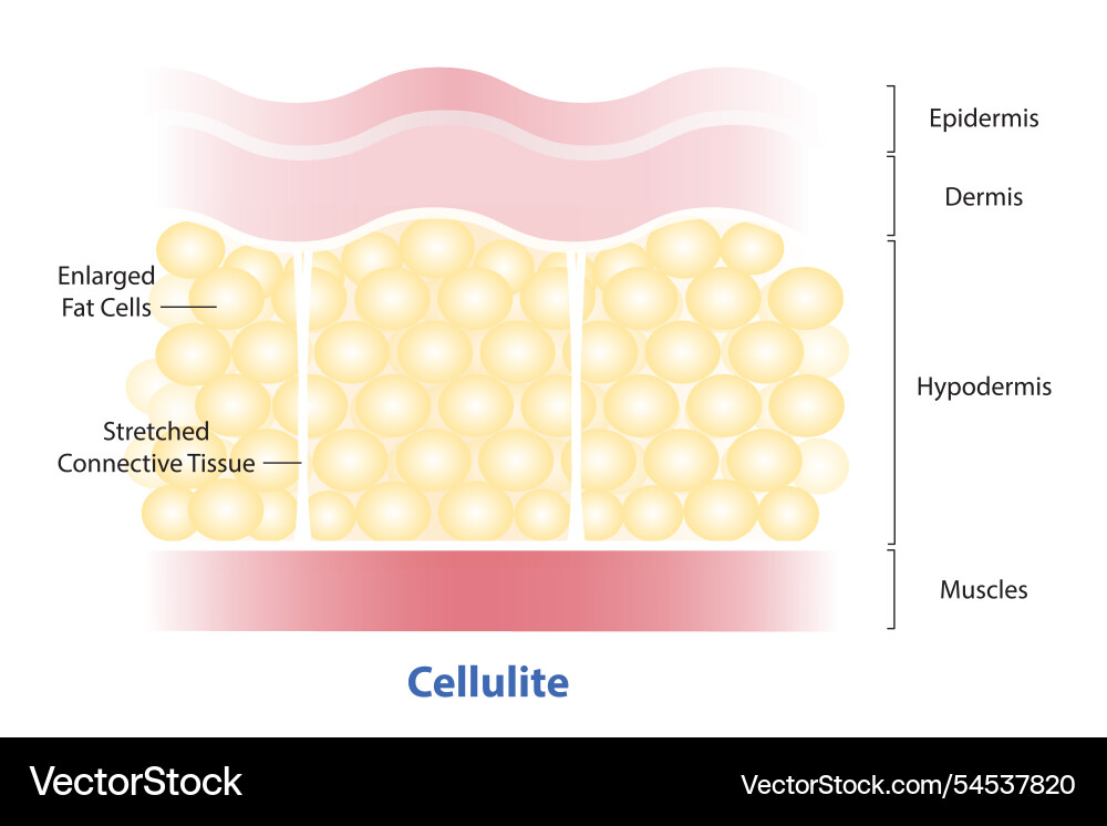 Formation of skin with cellulite Royalty Free Vector Image