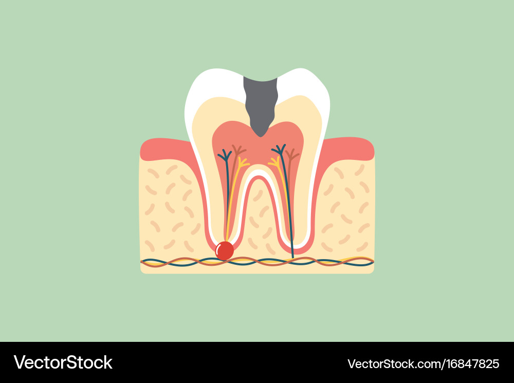 Decay tooth anatomy structure Royalty Free Vector Image