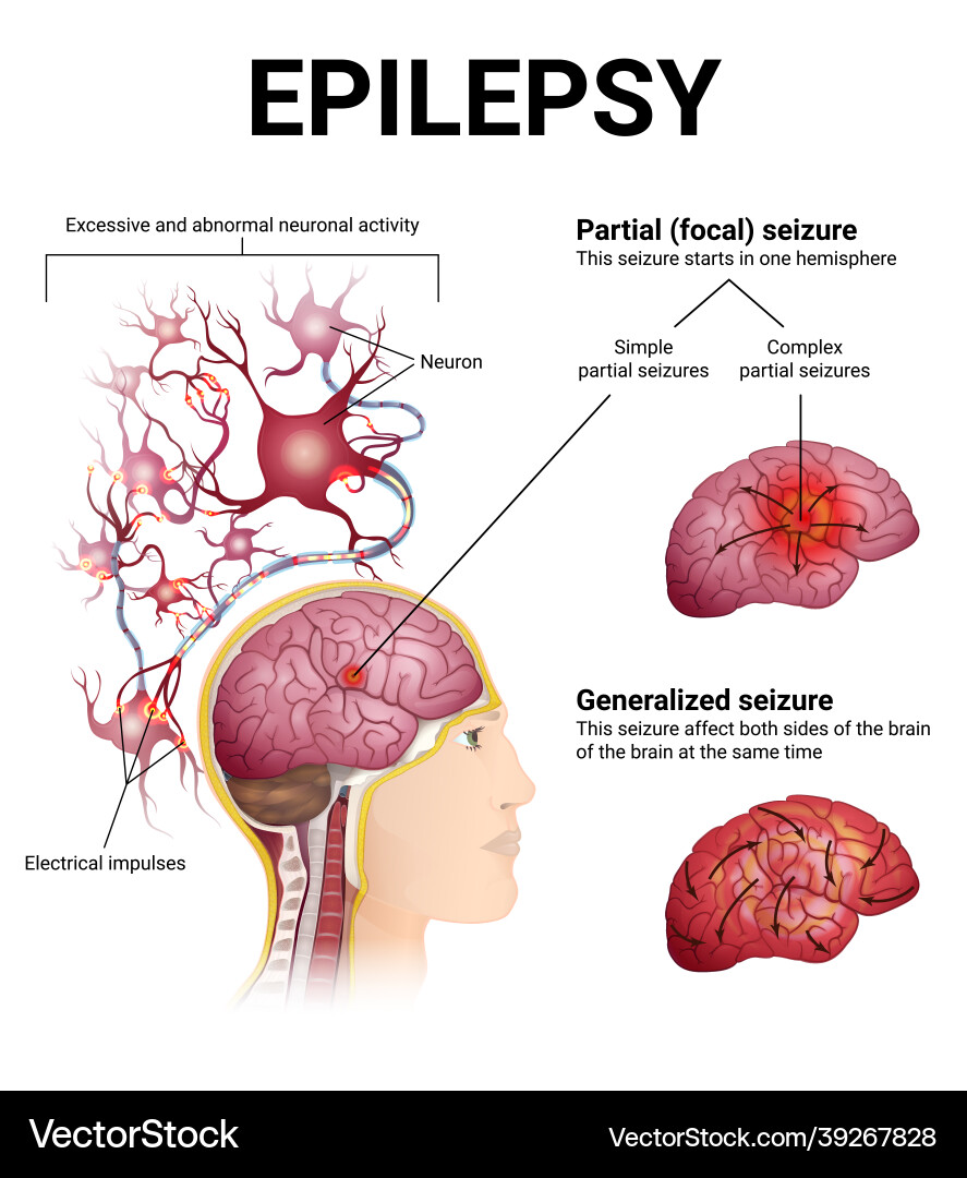 Epilepsy Brain Diagram Epilepsy Disease Symptoms, Causes, Types,
