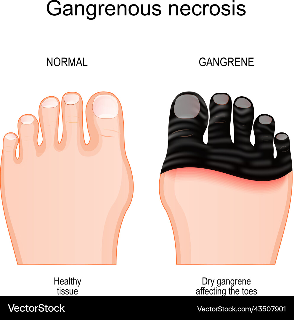 Gangrene affecting the toes tissue death Vector Image