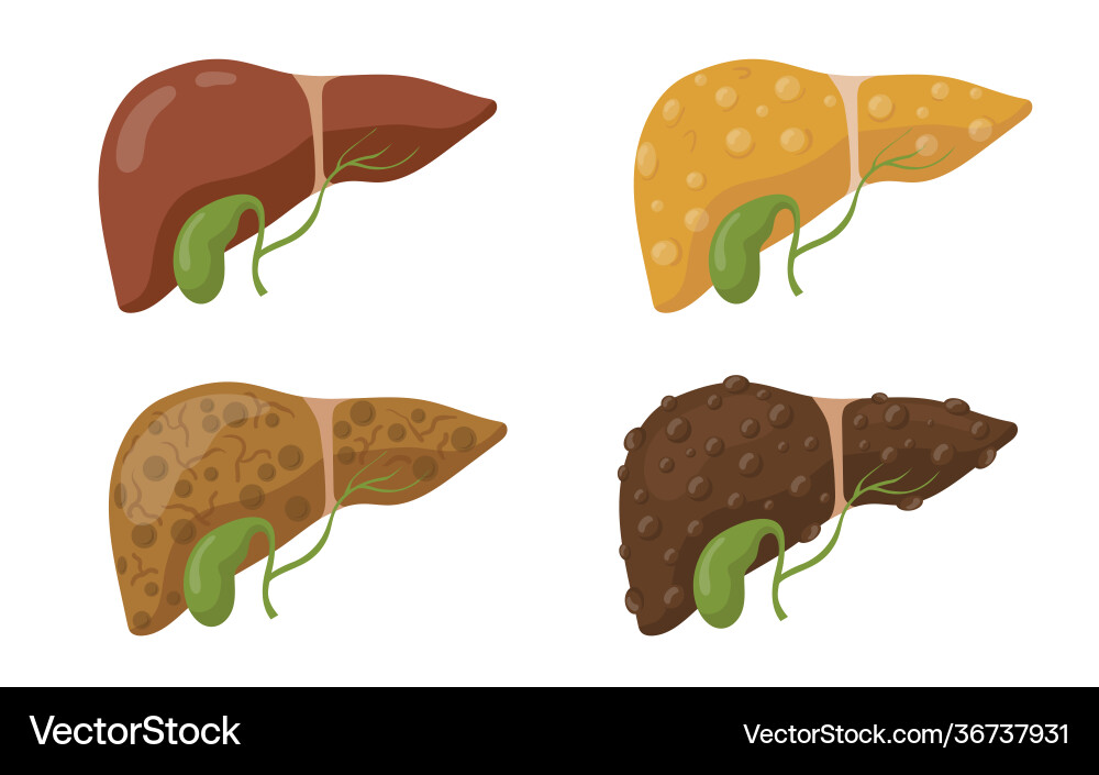 Human Liver Disease Stages Royalty Free Vector Image