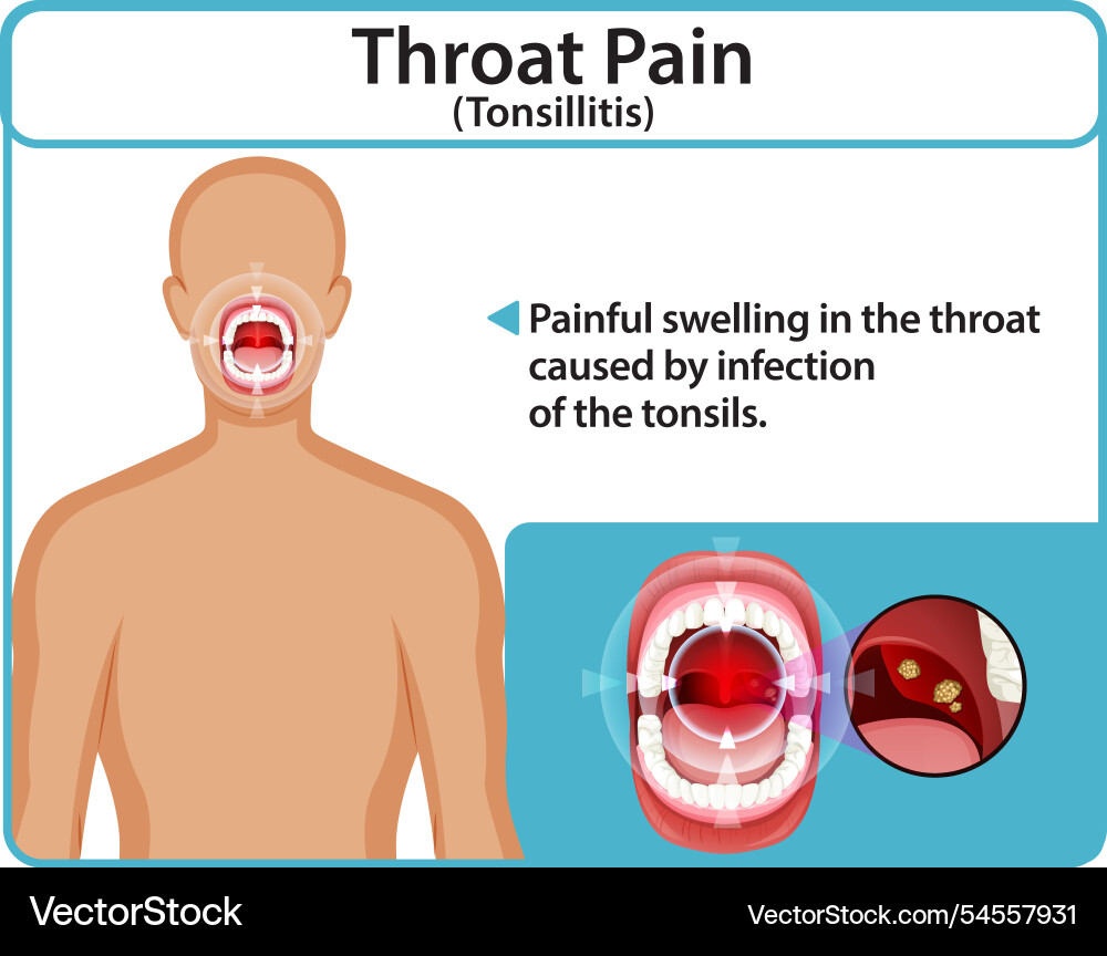 Tonsillitis symptoms and throat anatomy Royalty Free Vector