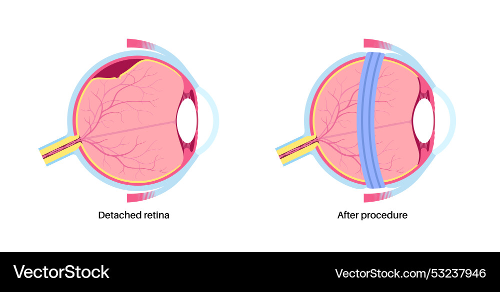 Scleral buckle procedure Royalty Free Vector Image
