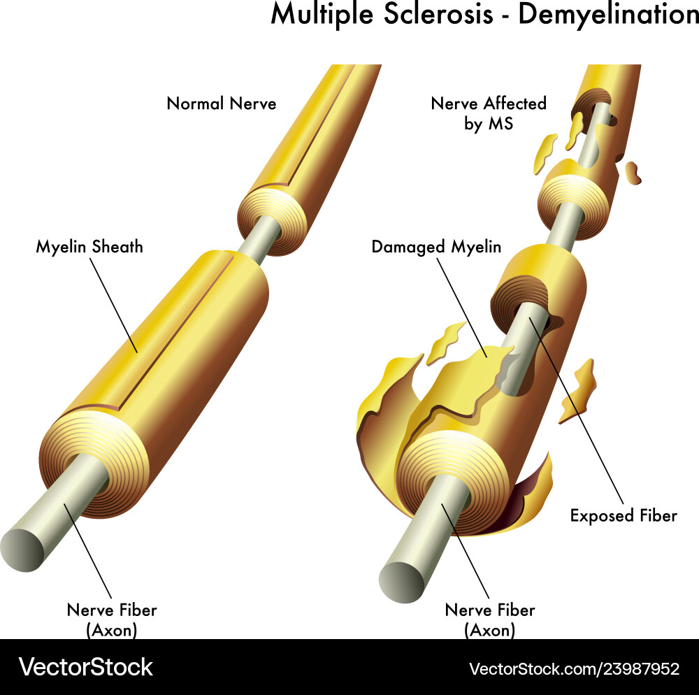 Multiple sclerosis nerve damage Royalty Free Vector Image
