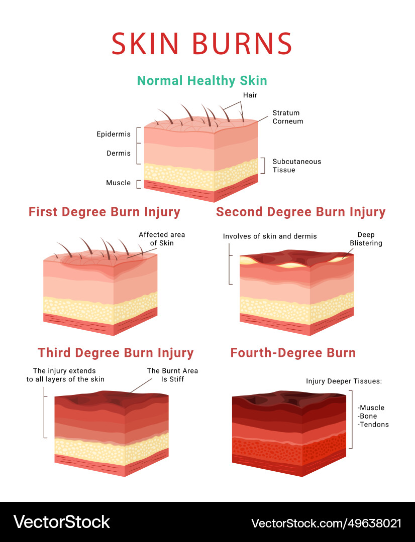 Skin burn classification infographic medical Vector Image