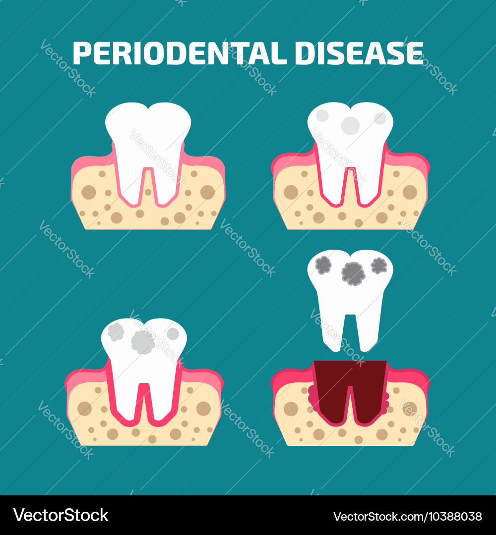 Periodontal disease icons set Royalty Free Vector Image