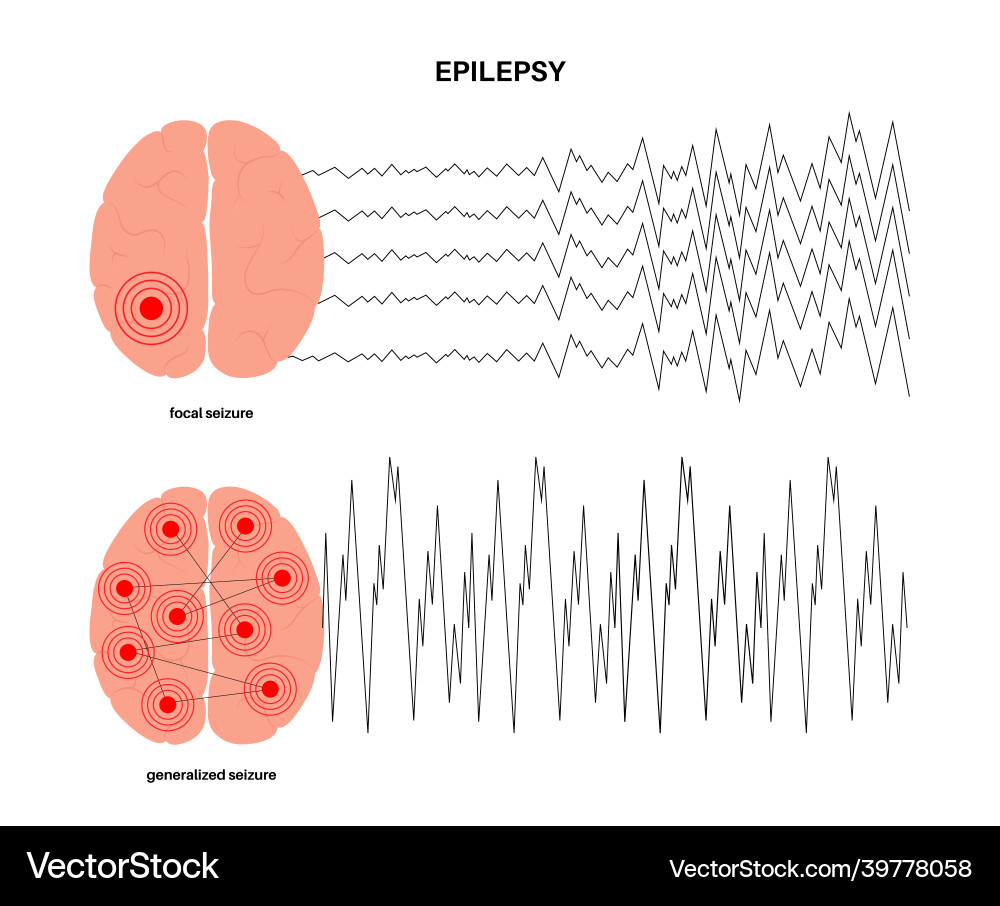 Epilepsy seizure concept Royalty Free Vector Image
