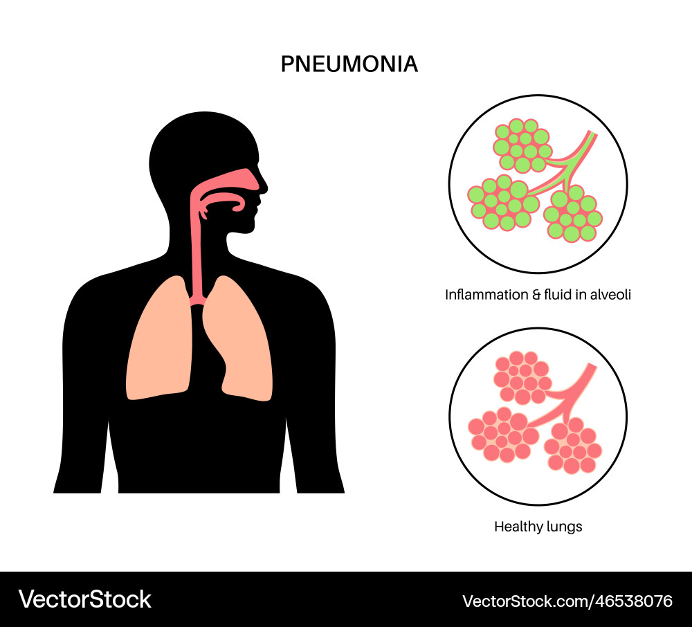 Pneumonia infection poster Royalty Free Vector Image