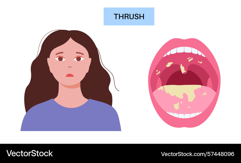 Thrush disease poster Royalty Free Vector Image