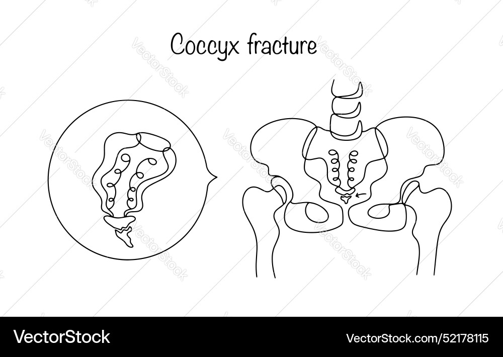 Coccyx fracture Royalty Free Vector Image - VectorStock