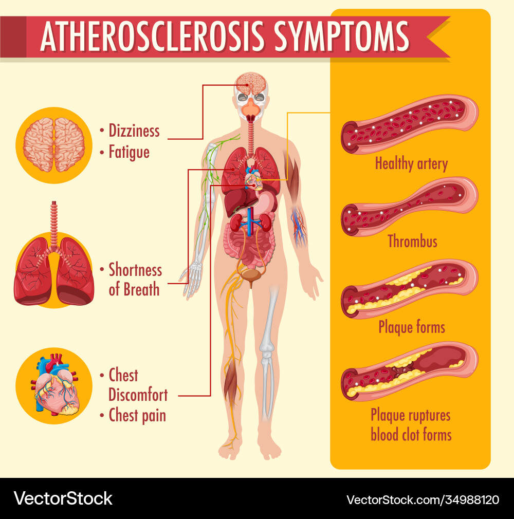 Stages atherosclerosis information infographic Vector Image