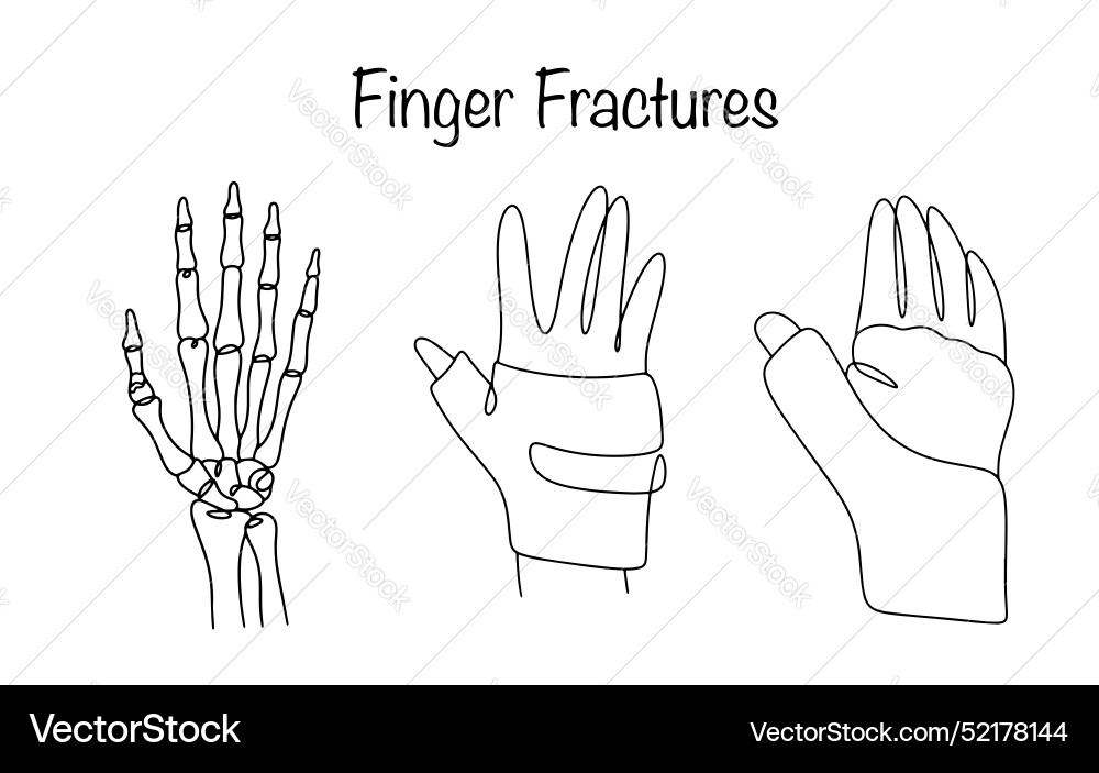 Finger Fractures Royalty Free Vector Image Vectorstock