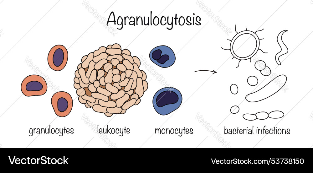 Agranulocytosis Royalty Free Vector Image - VectorStock