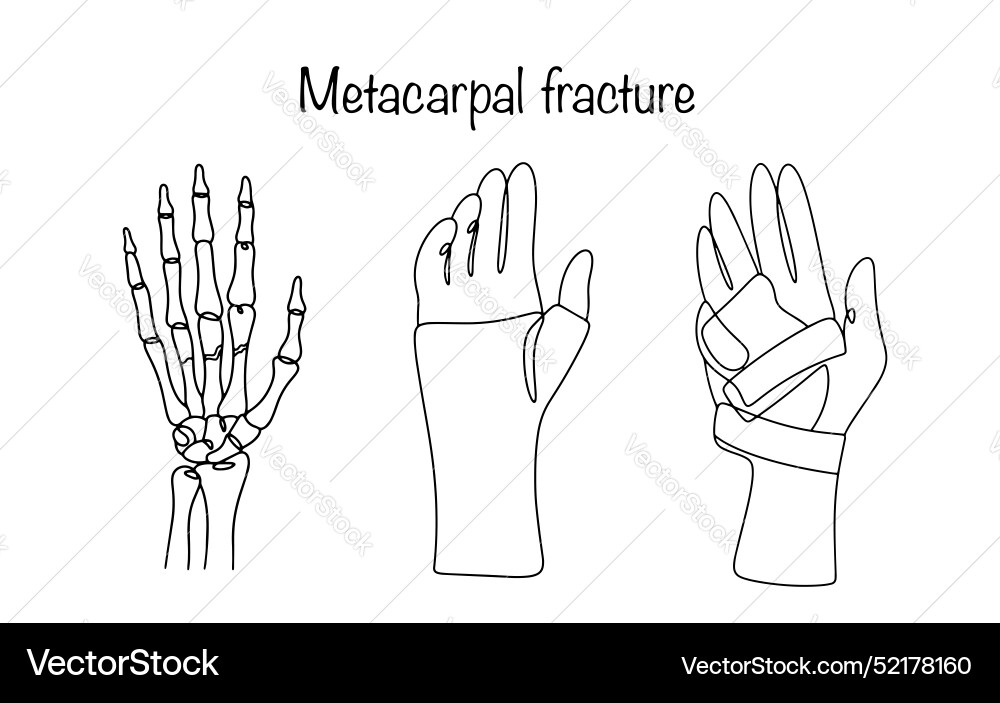 Metacarpal Fracture Royalty Free Vector Image Vectorstock