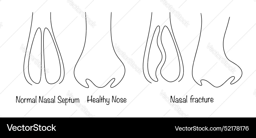 Nasal fracture nose Royalty Free Vector Image - VectorStock