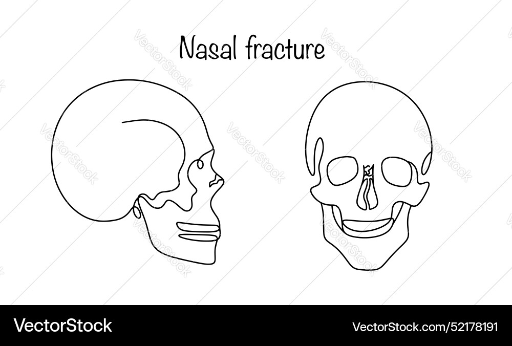 Nasal fracture Royalty Free Vector Image - VectorStock