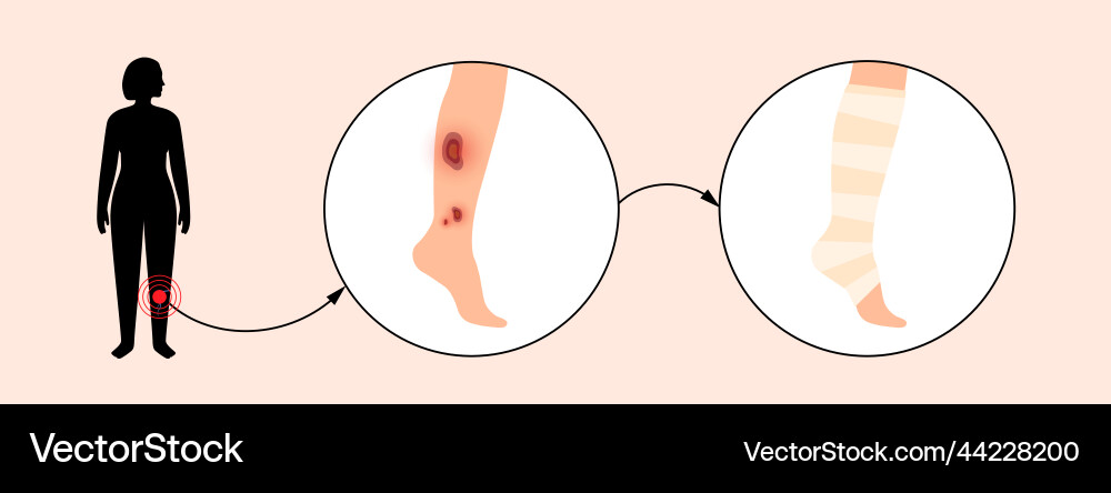 Human leg injury Royalty Free Vector Image - VectorStock