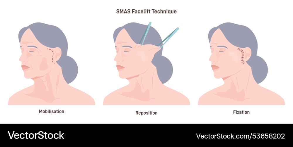 Smas facelift surgery face features correction Vector Image