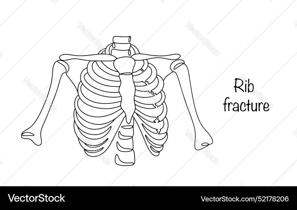 Rib fracture Royalty Free Vector Image - VectorStock