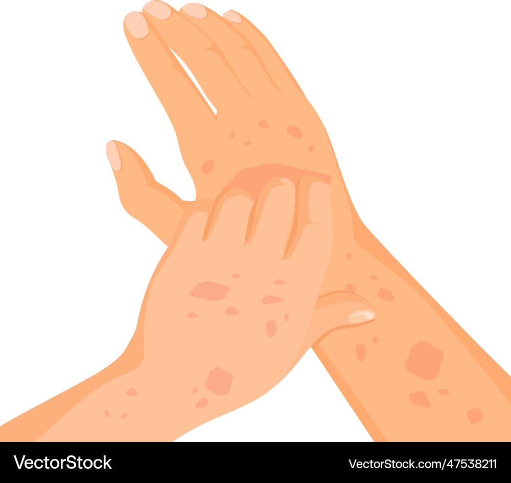 Rash skin on hand rashes itching hands scratch Vector Image