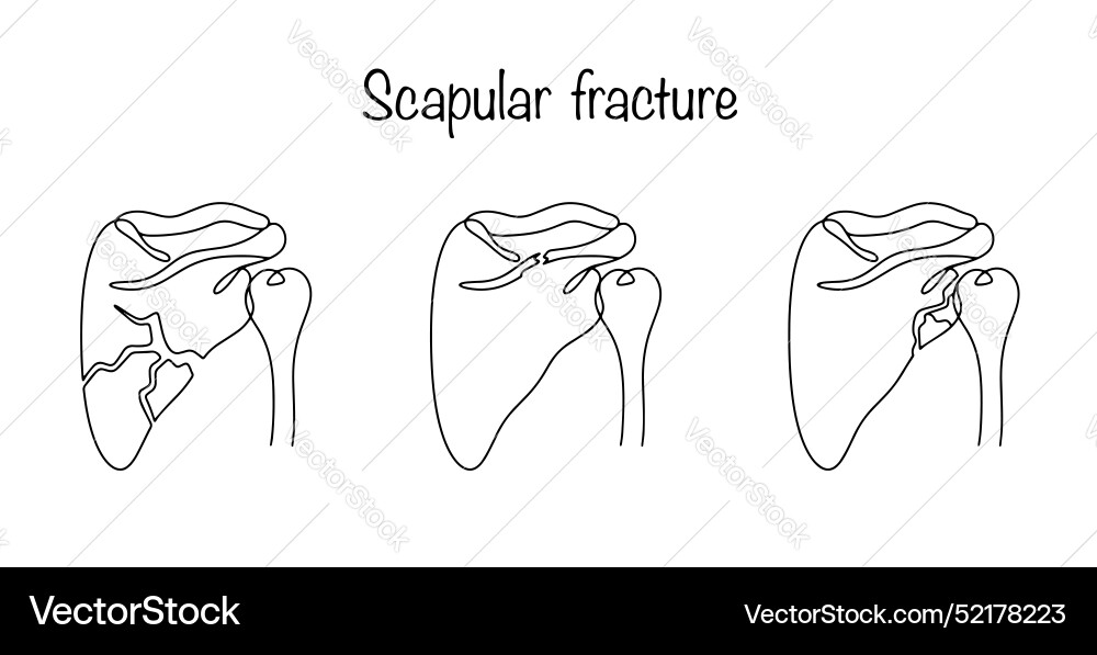 Scapular Scapula Fracture Fractures Intraarticular Approach Surgery ...