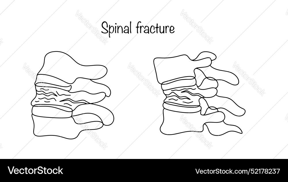 Spinal fracture Royalty Free Vector Image - VectorStock