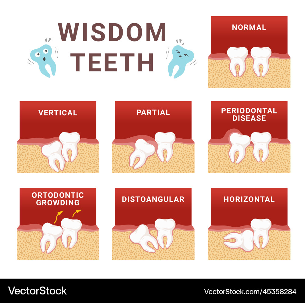 Wisdom teeth impaction scheme dentistry medical Vector Image