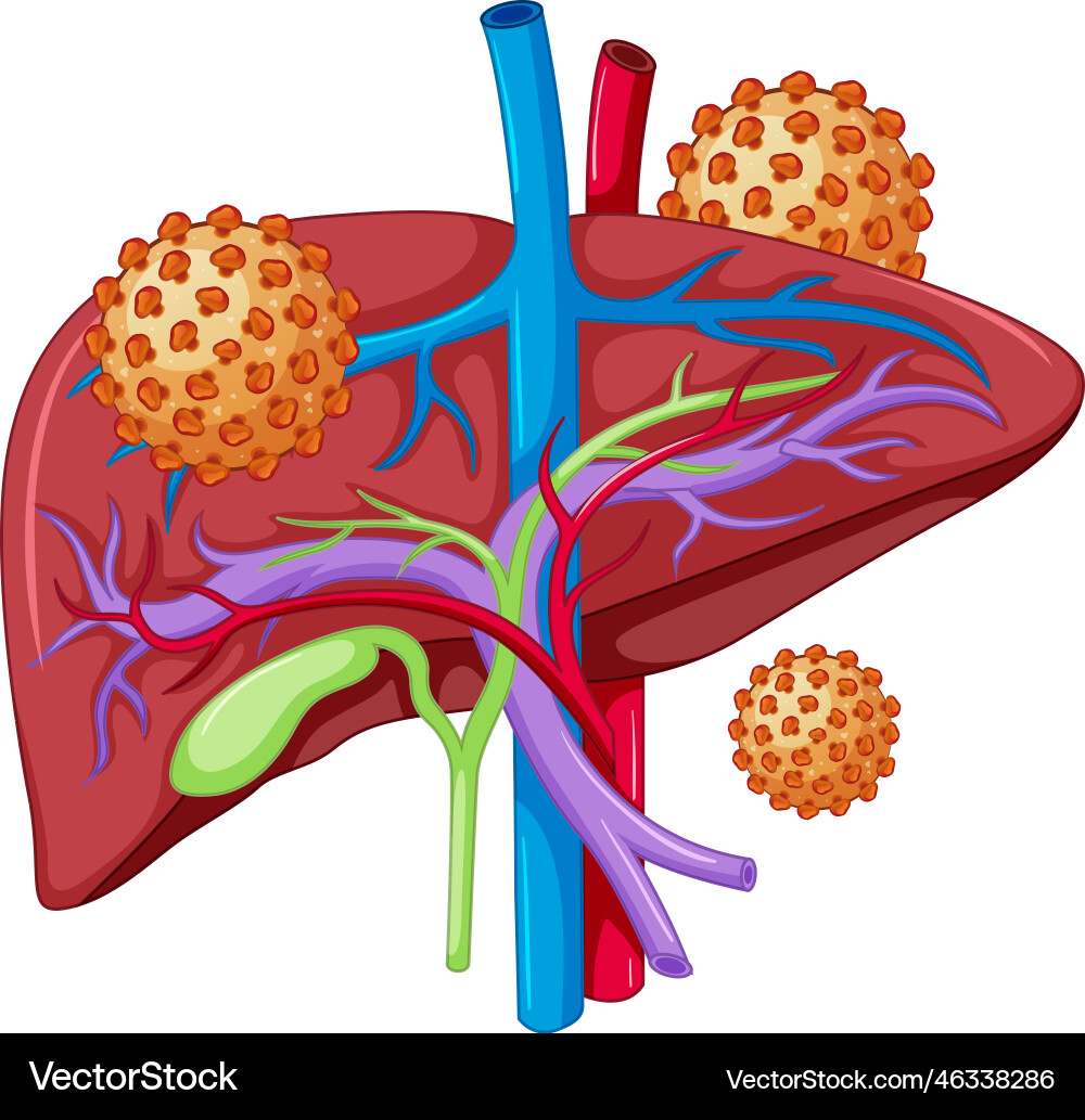 Hepatitis b liver infection virus Royalty Free Vector Image
