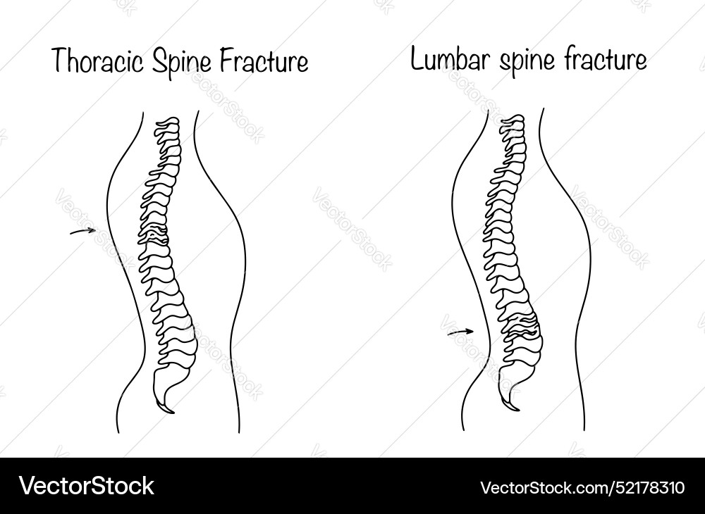 Types of spinal fracture Royalty Free Vector Image